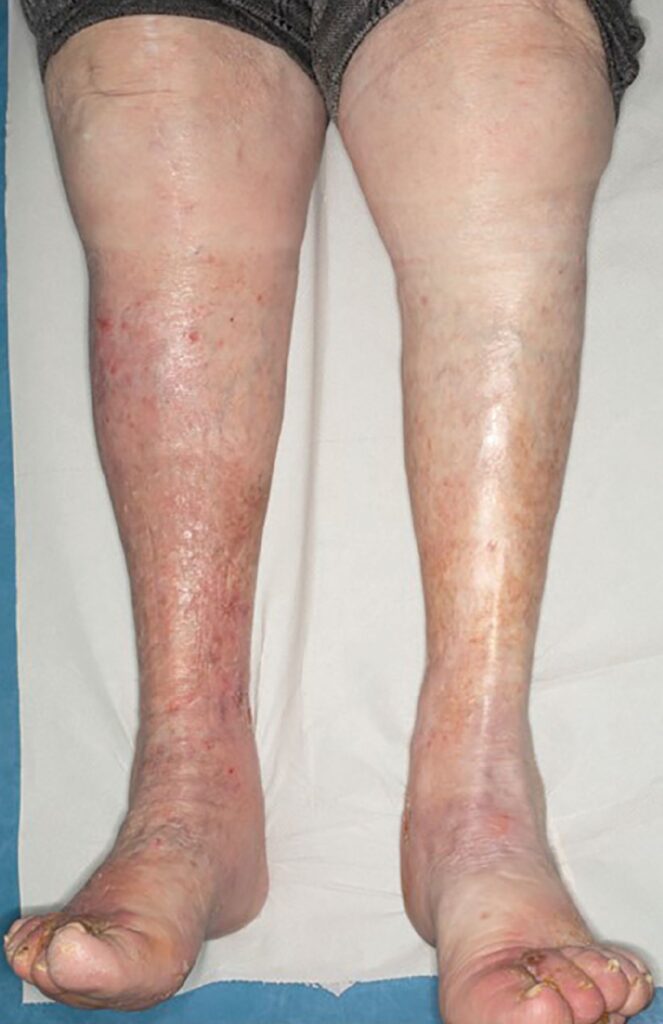 Chronic Deep Venous Obstruction - Dr Karthikeyan Damodharan