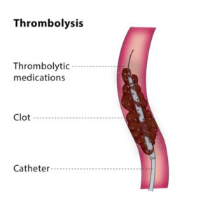 Thrombolysis /thrombectomy for deep vein thrombosis (DVT) - Dr ...