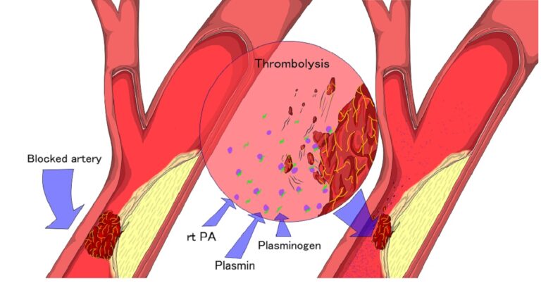 Thrombolysis / mechanical thrombectomy for acute arterial thrombosis - Dr Karthikeyan Damodharan
