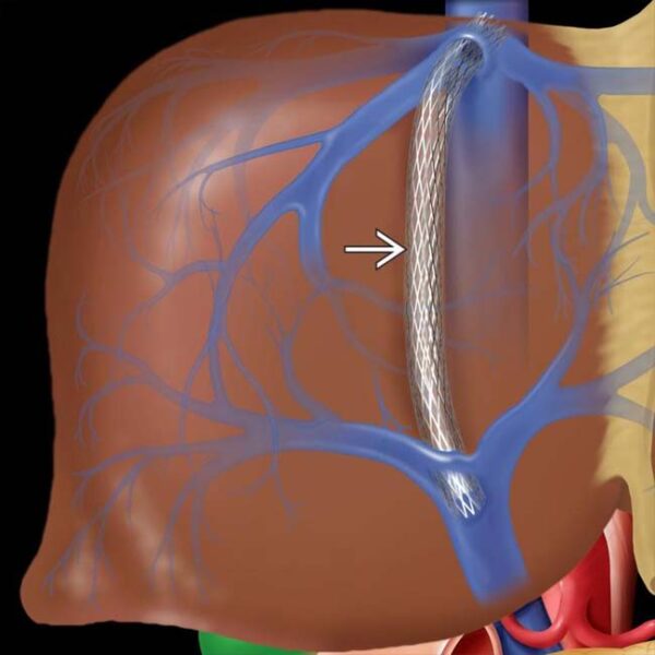 Transjugular portosystemic stent shunt creation - Dr Karthikeyan Damodharan