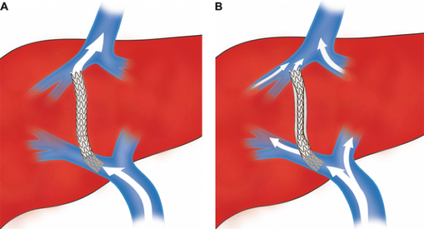 Transjugular portosystemic stent shunt reduction - Dr Karthikeyan ...