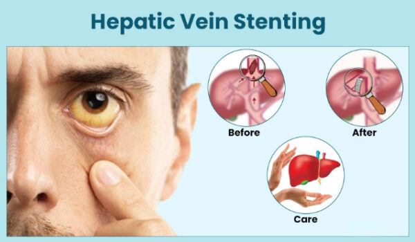 Hepatic vein or Inferior vena cava stenting for Budd Chiari syndrome ...