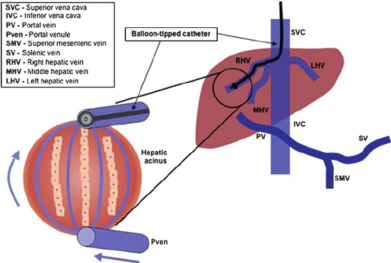 Hepatic Venous portal gradient measurement - Dr Karthikeyan Damodharan