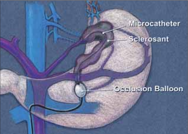 Balloon occluded retrograde Transvenous obliteration for gastric ...