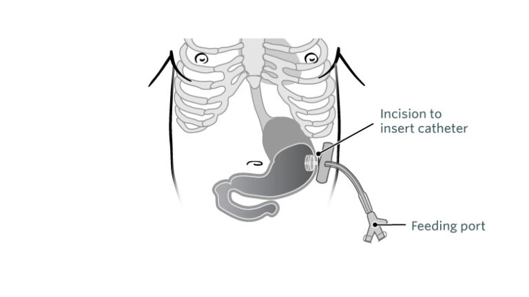 Image guided percutaneous gastrostomy / gastrojejunostomy tube ...