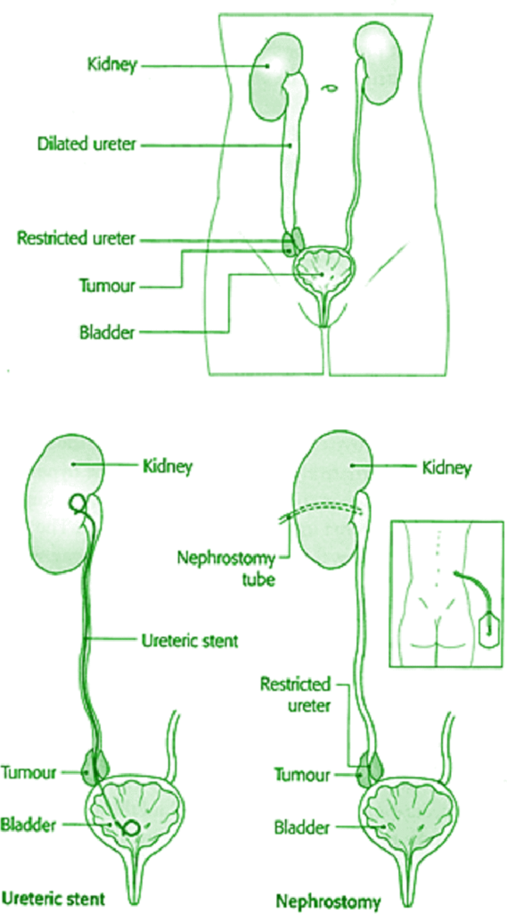 Antegrade ureteric stenting - Dr Karthikeyan Damodharan