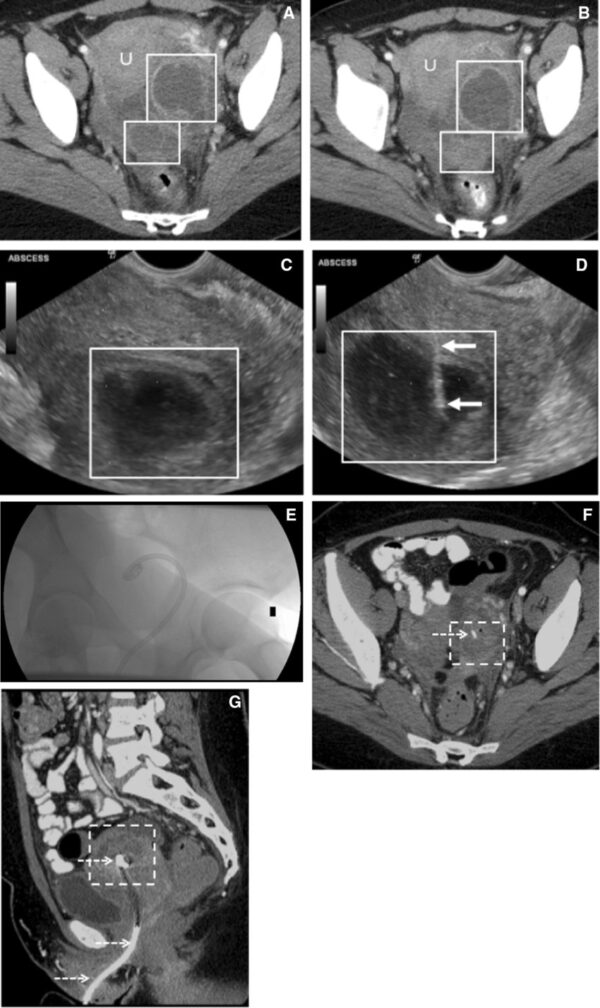 Transvaginal ultrasound guided drainage of pelvic collection - Dr ...